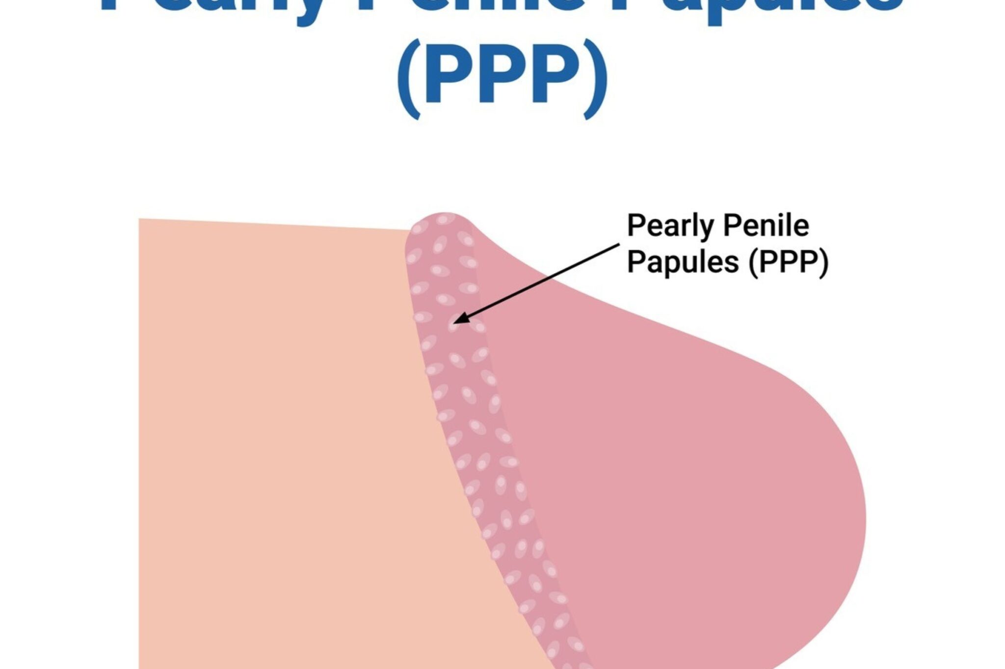 Understanding Male Intimate Skin Health: How Much Does Pearly Penile ...