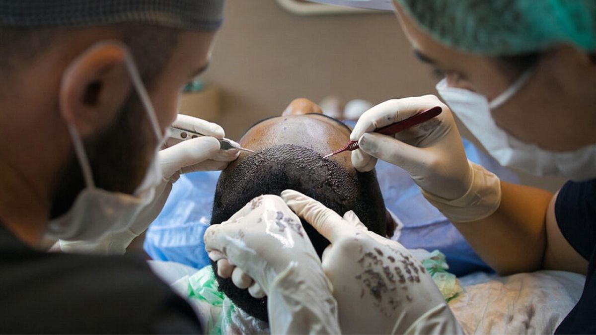 Does Hair Transplant Surgery Work? | Medical News Bulletin